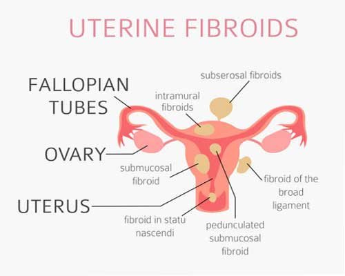 Best Uterine Fibroids, Garbhashay Ganth Treatment In India - Ace ...